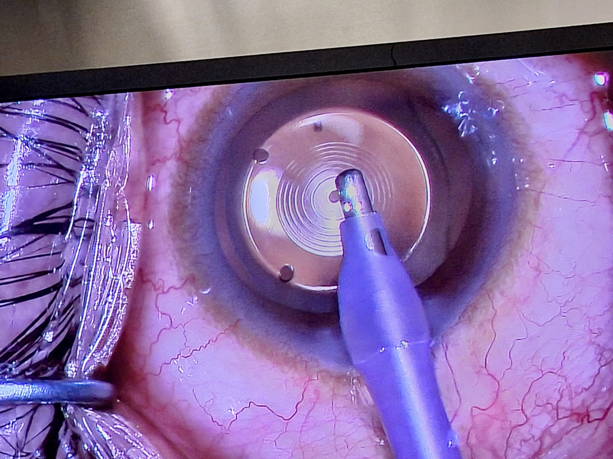 当院ではIPCL手術も行なっております | 医療法人水晶会安里眼科